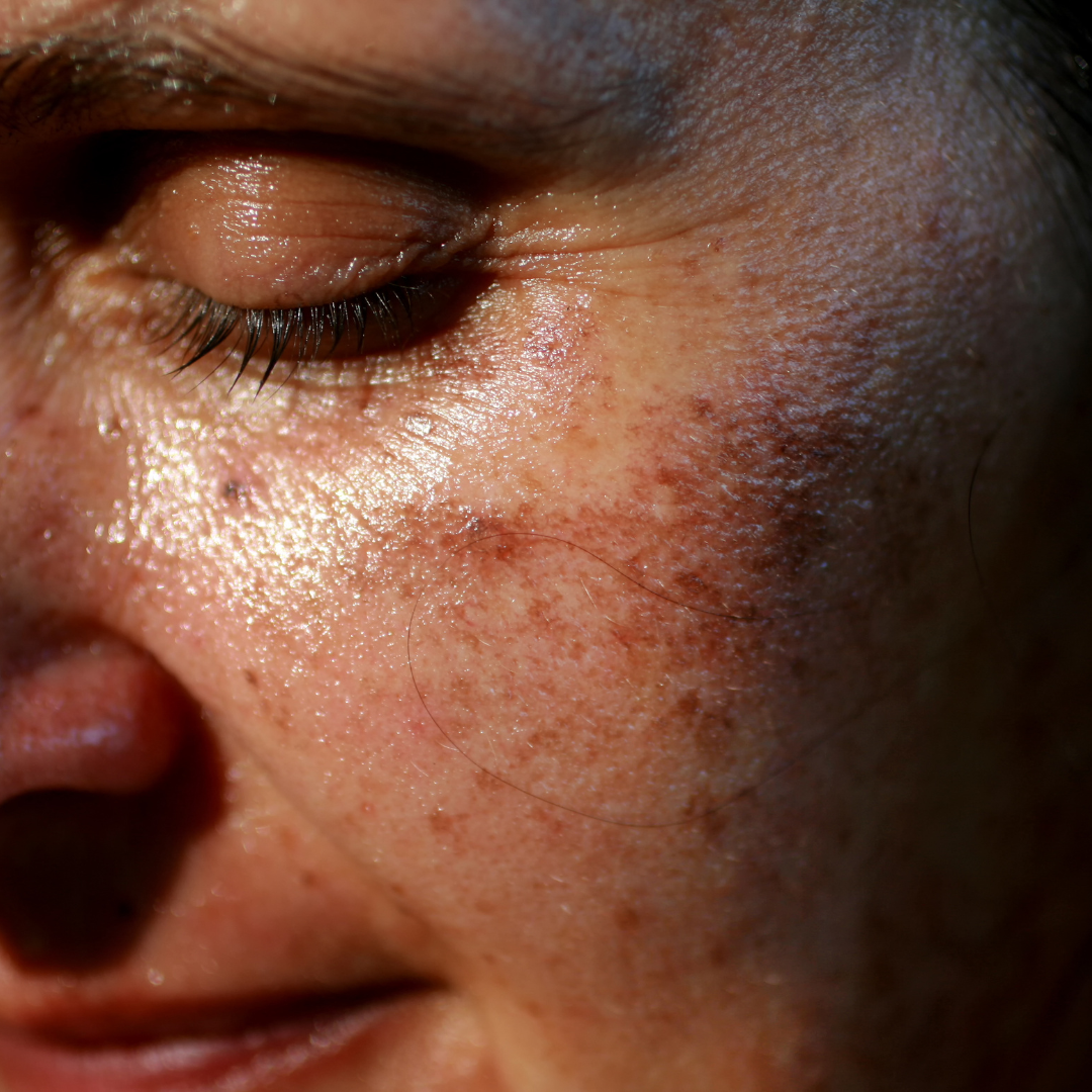 Rosacea: Causes and Symptom Management – Hark & Zander